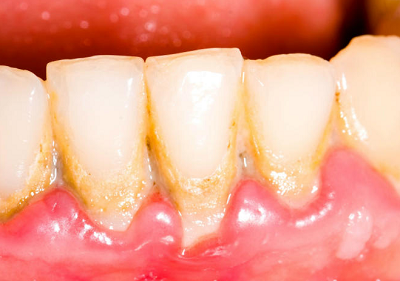 Calculus: What Is It? | Algodones Dentists Guide